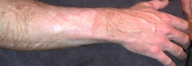 3rd Degree Burn Scar Back